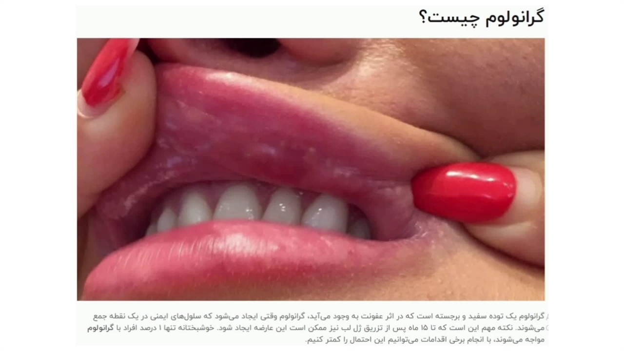 گرانولوم ناشی از تزریق لب چیست؟ [5 راه پیشگیری از آن] - نماشا